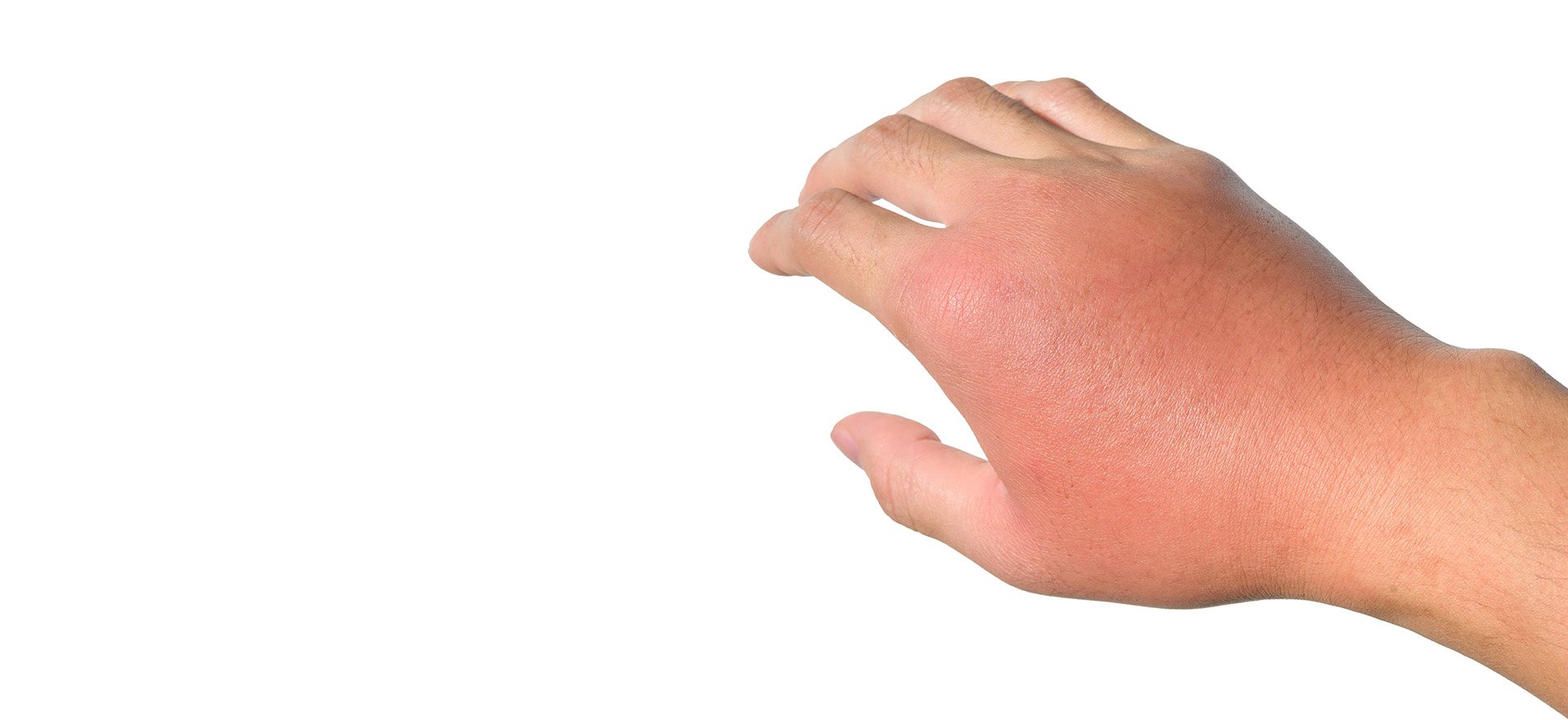 Effective Cellulitis Treatment in NJ | Premier Surgical Network