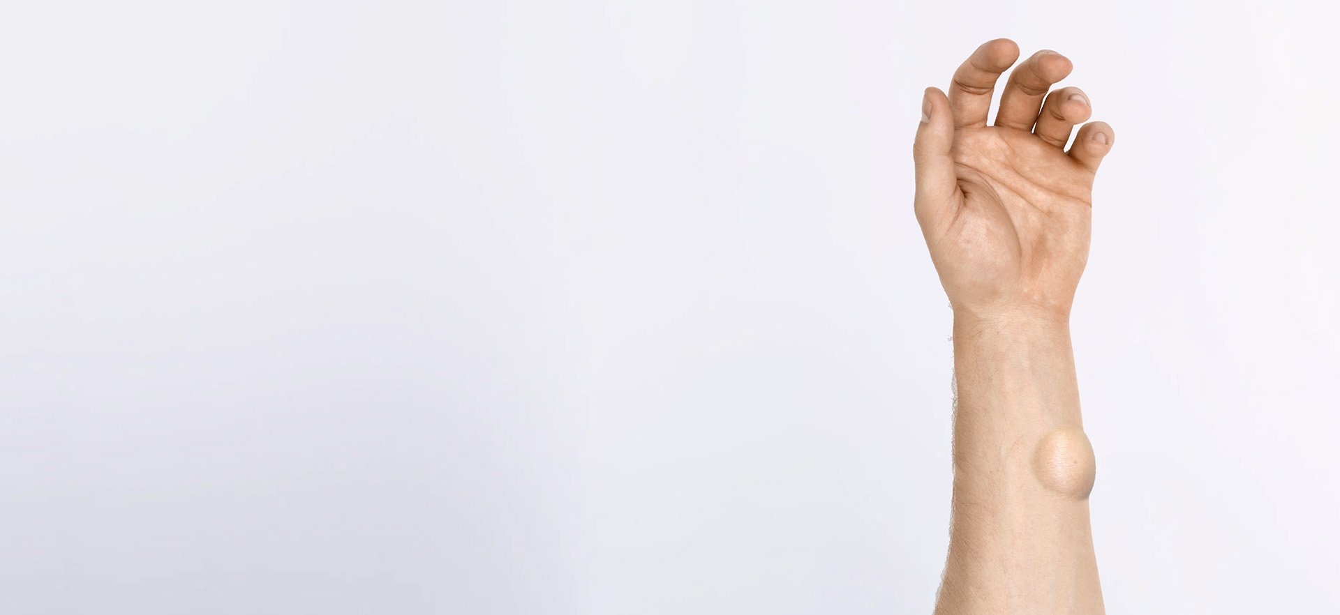 Effective Lipoma Removal Procedures: Safe and Minimally Invasive Options