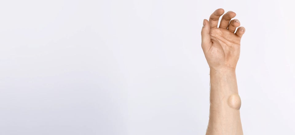 Effective Lipoma Removal Procedures: Safe and Minimally Invasive Options