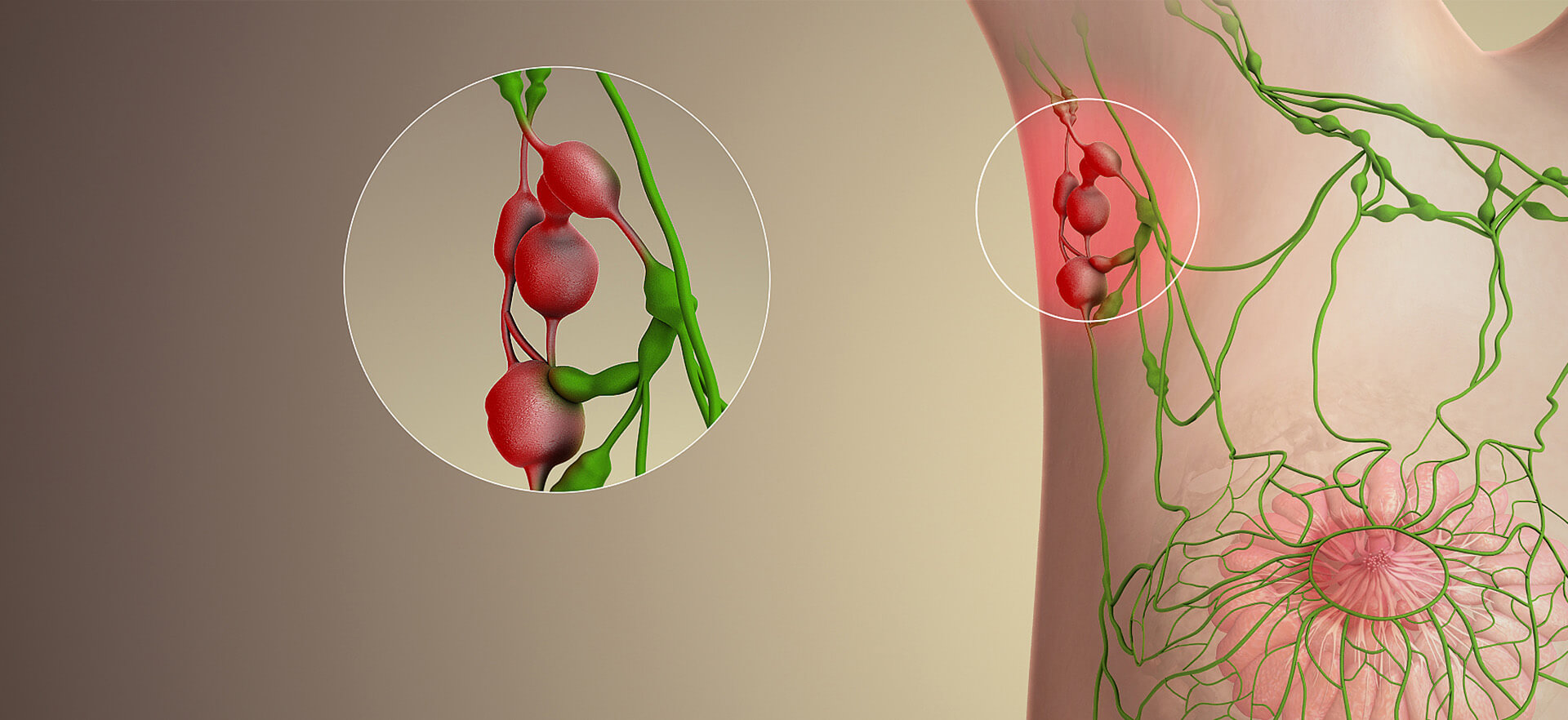 Sentinel Lymph Node Biopsy