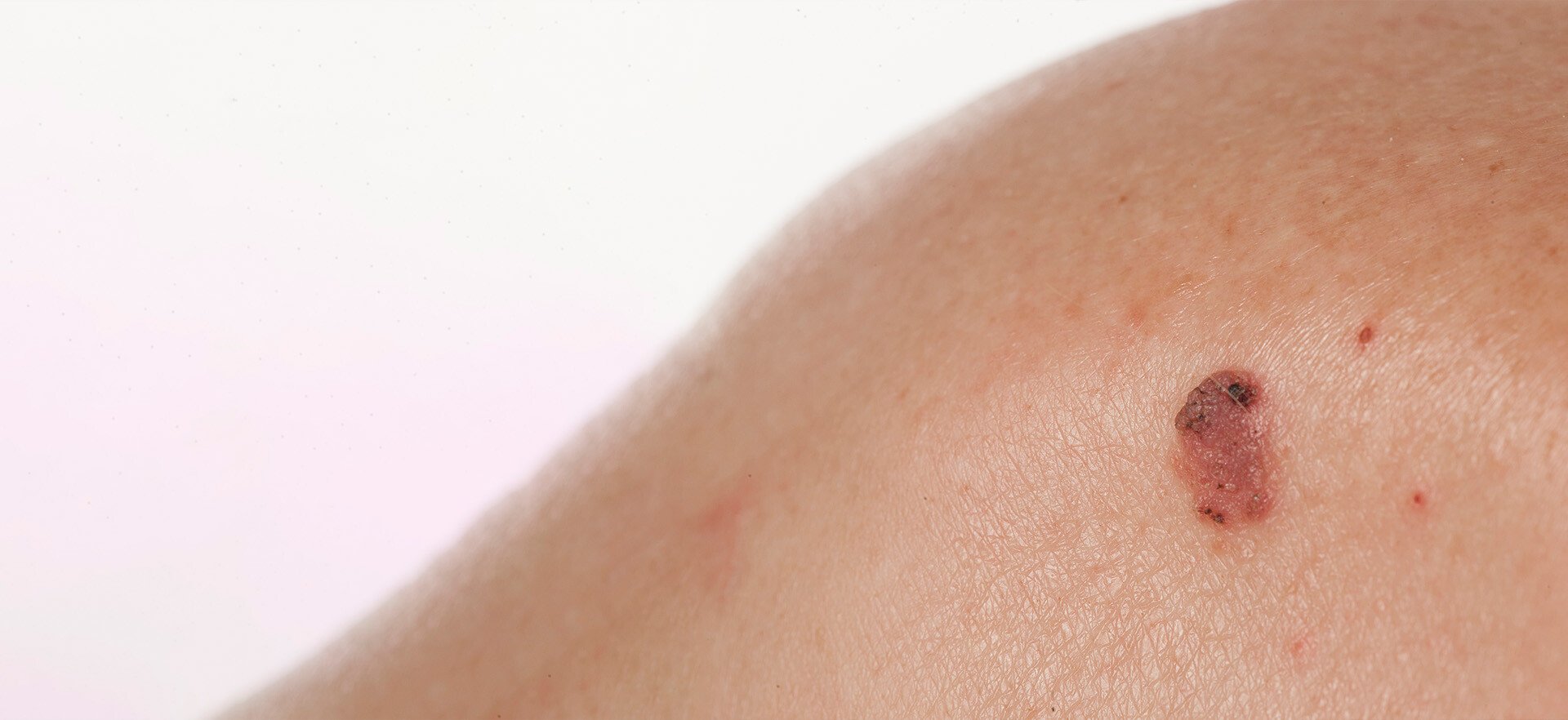 Understanding Squamous Cell Carcinoma: Symptoms and Treatment Options