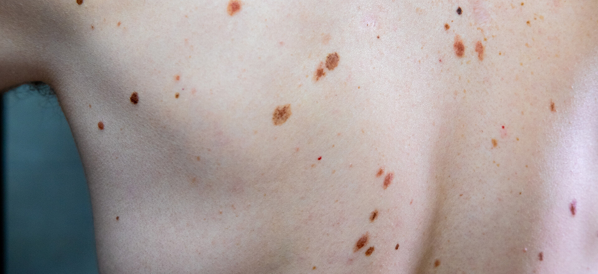 Suspicious Nevi Evaluation & Treatment | Premier Surgical Network